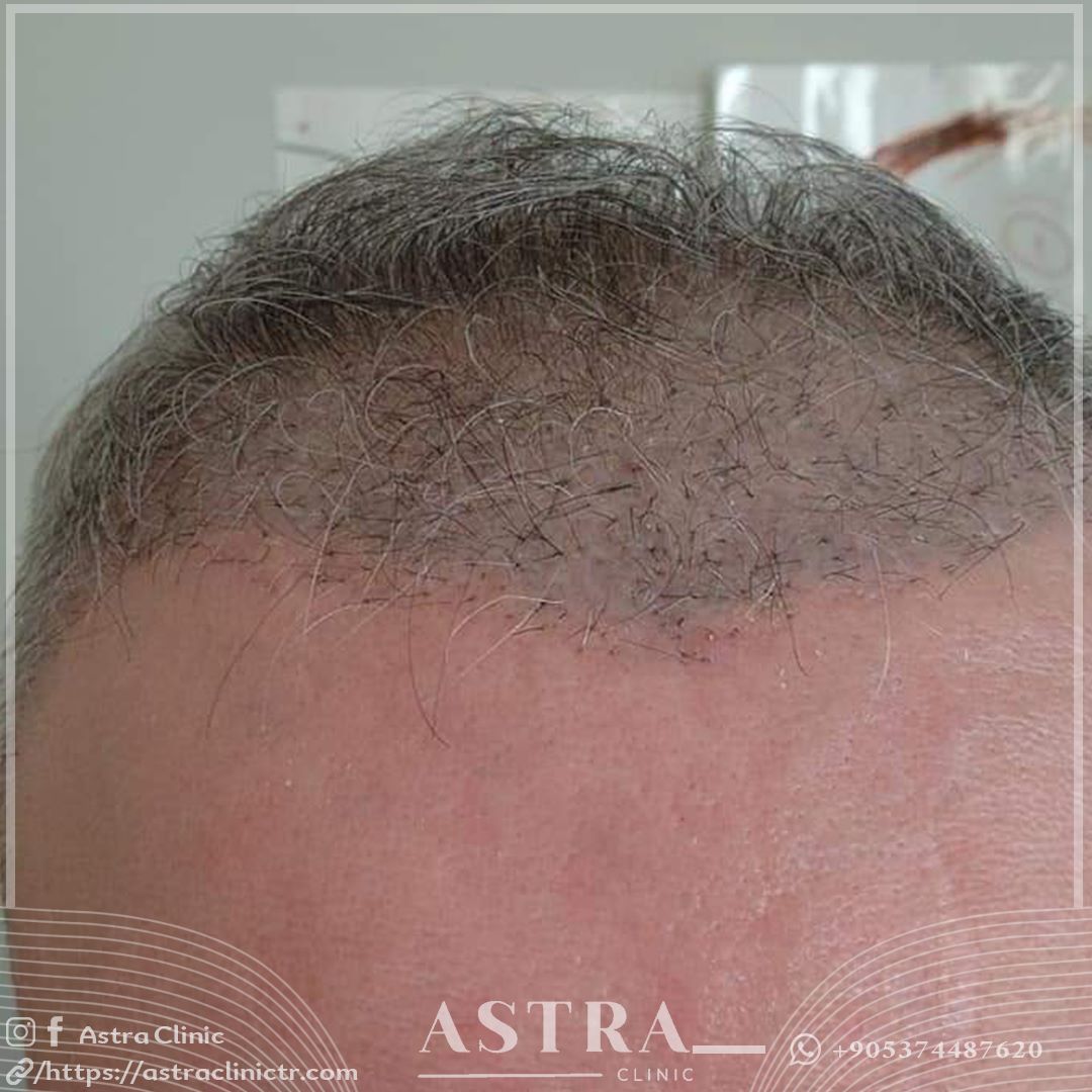 Hair Transplant Aston Clinic